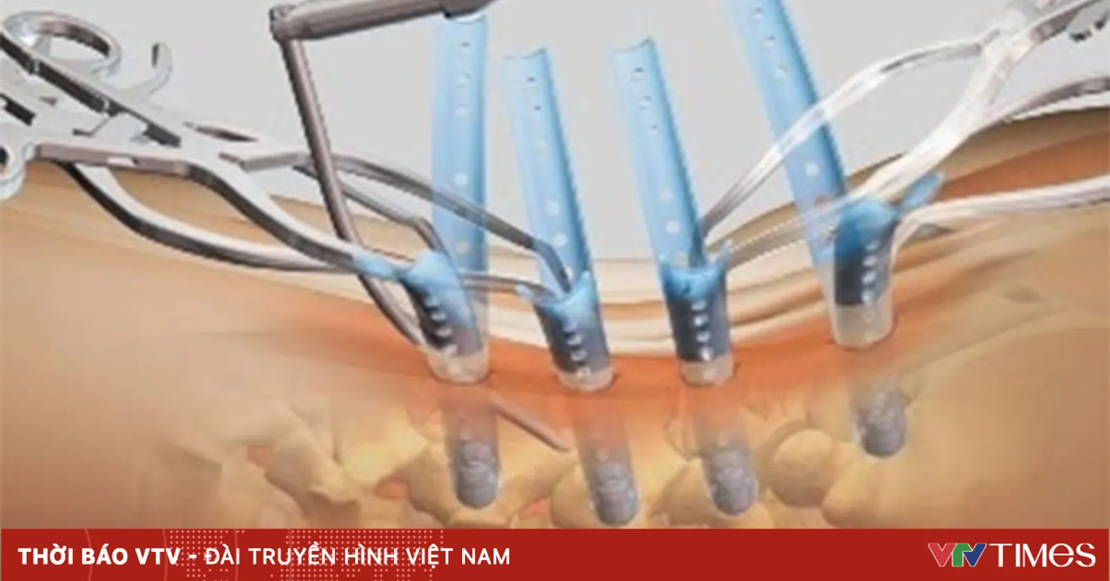 Vít cố định xương tự tiêu trong cơ thể