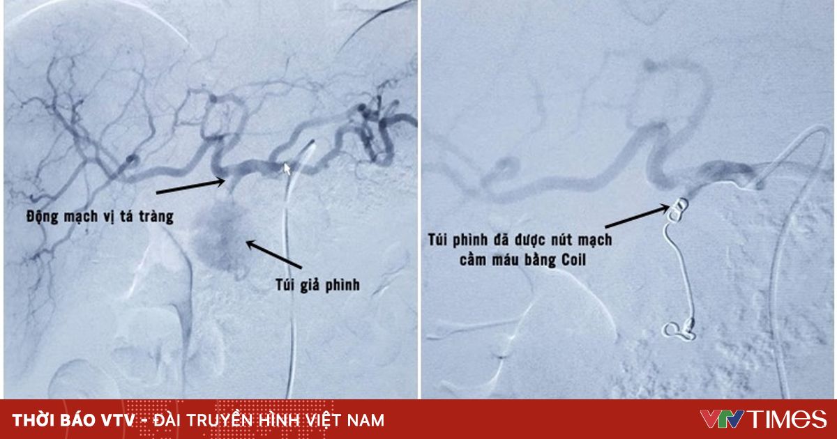 Nút mạch điều trị giả phình động mạch tá tràng cho bệnh nhân