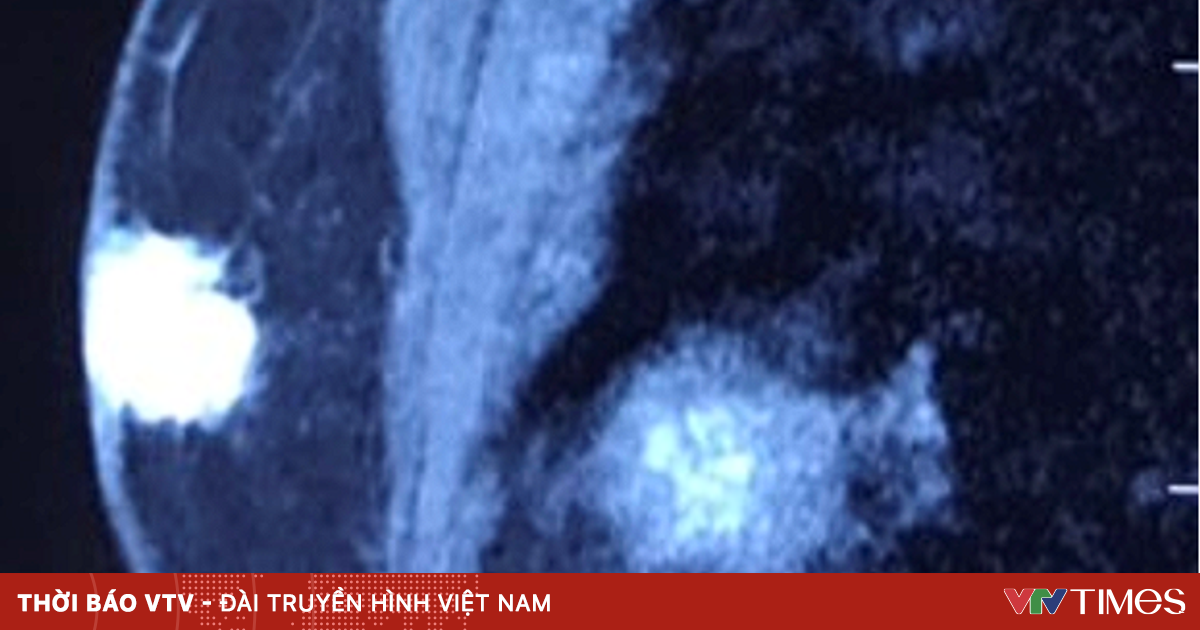 Paget vú - Loại ung thư vú thầm lặng nguy hiểm