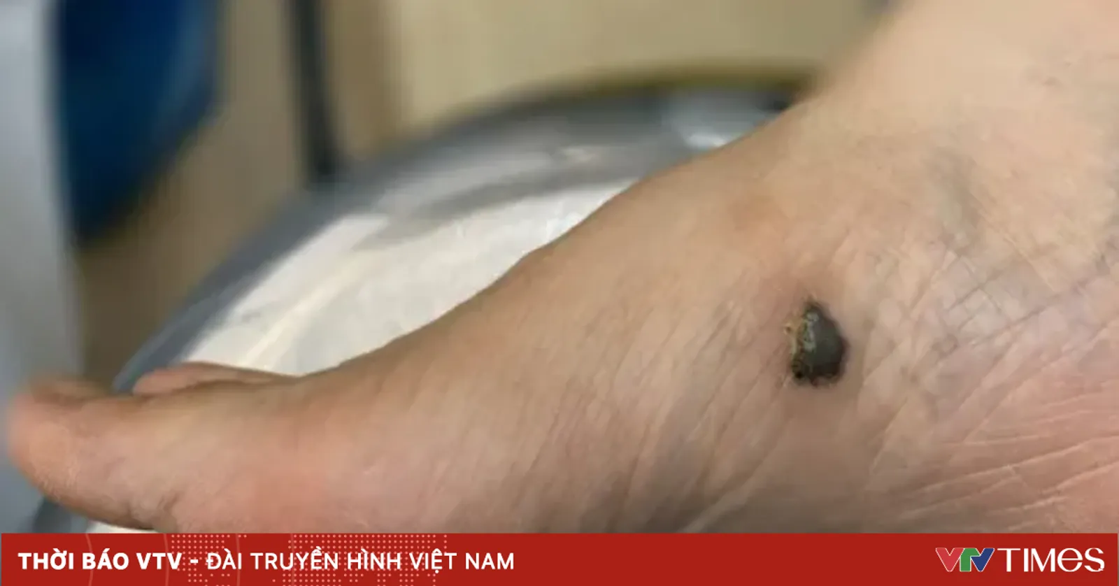 Ung thư tế bào hắc tố ở bàn chân
