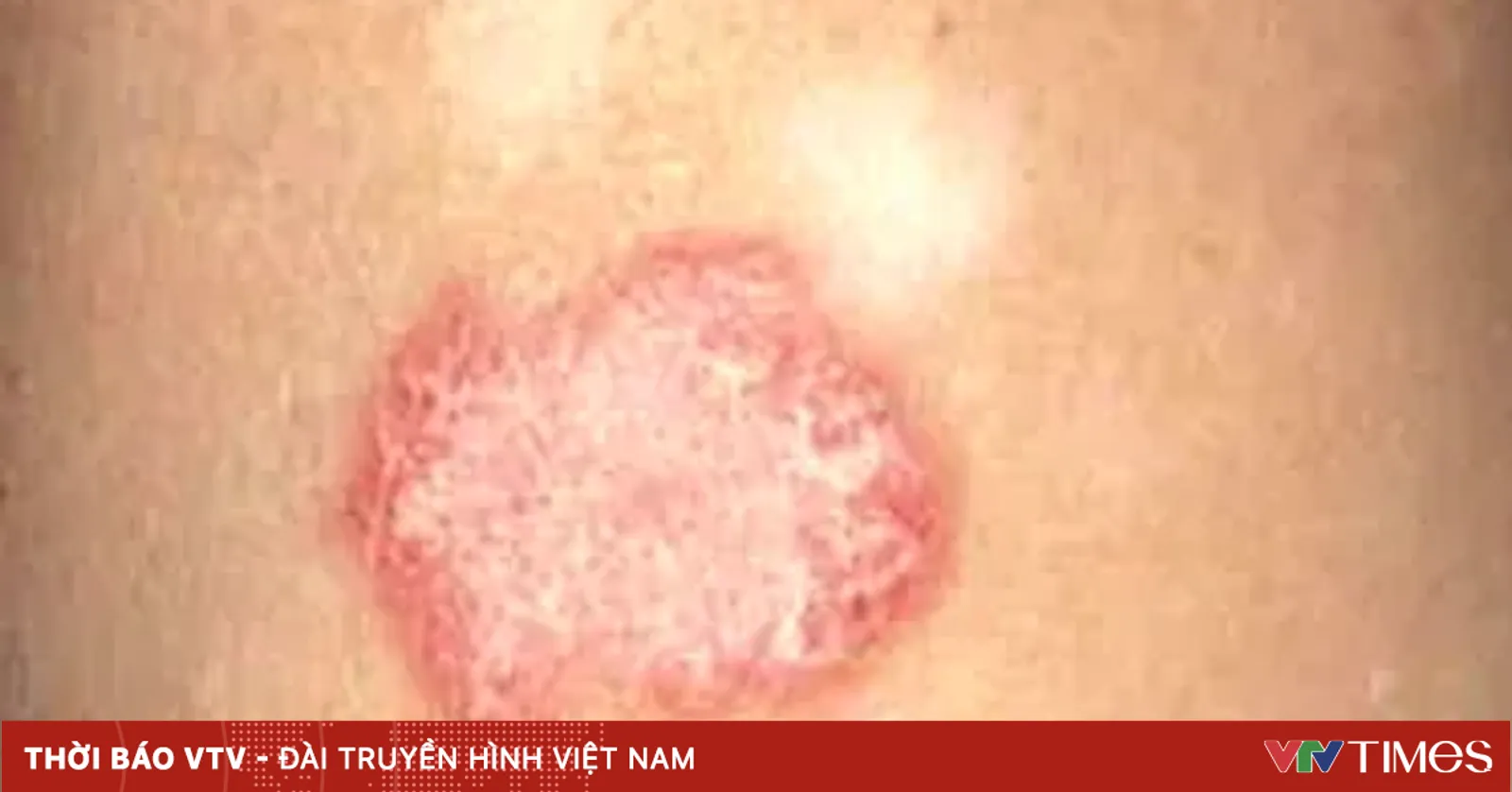 Lupus ban đỏ - Căn bệnh tự miễn thầm lặng và nguy hiểm