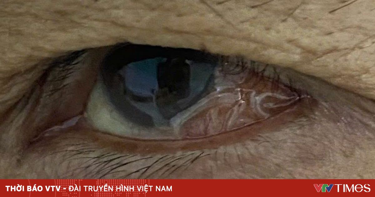 Phẫu thuật lấy con giun dài 14 cm ký sinh trong... mắt bệnh nhân