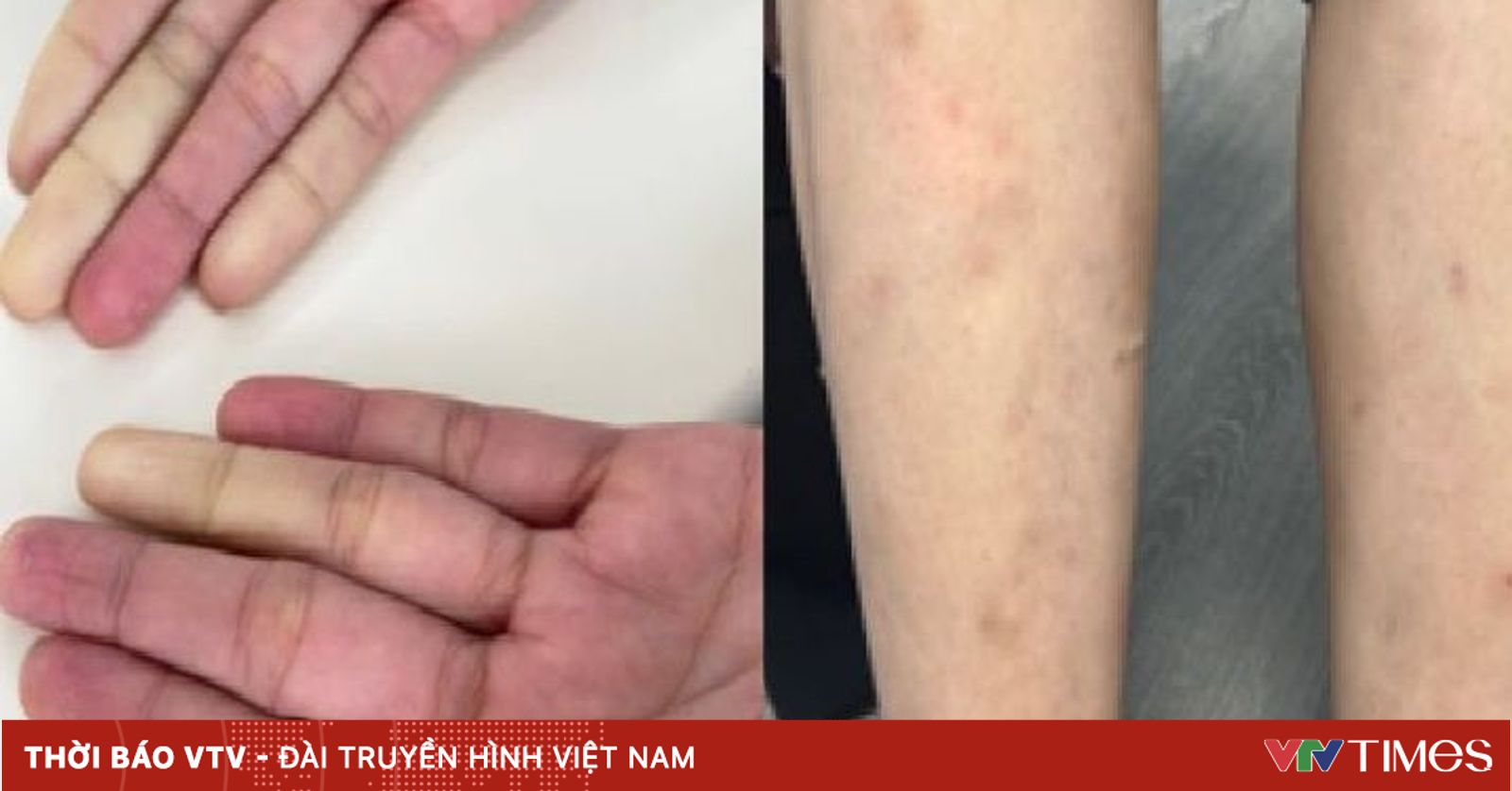Người phụ nữ mắc bệnh tự miễn hiếm gặp