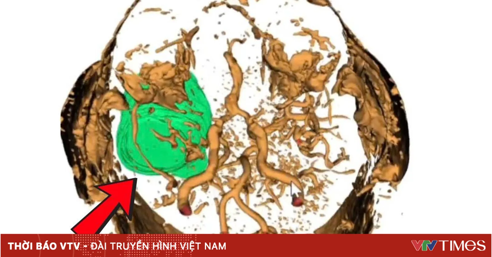 Vi phẫu khối u màng não kích thước lớn vùng nền sọ cho bệnh nhân