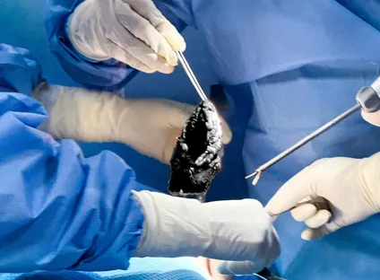 Breast Augmentation Complications: Capsular Contracture, Implant ...